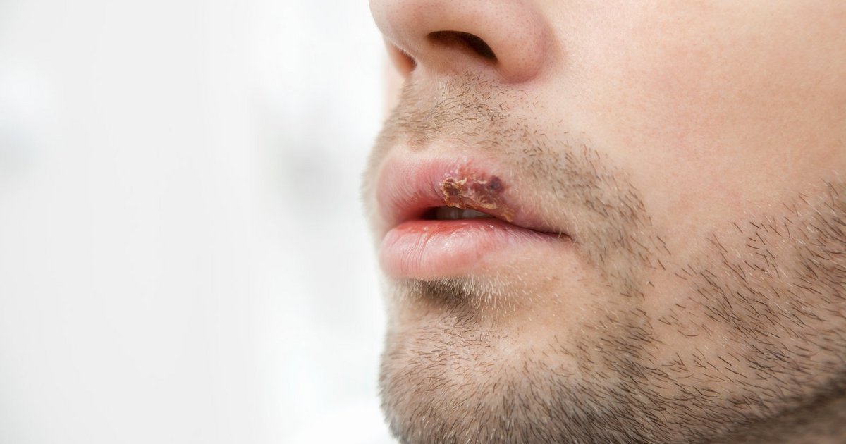 Opryszczka. Jakie są jej przyczyny, objawy i sposoby leczenia?: ŁÓDŹ.PL